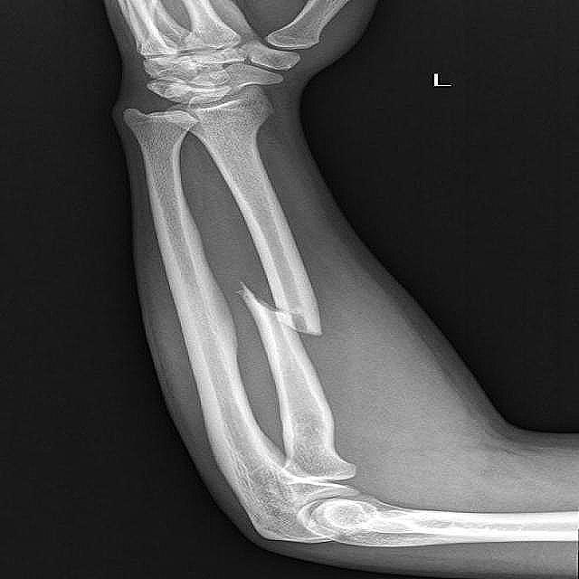 Bone facture Object Detection Dataset and Pre-Trained Model by CodeWithCat