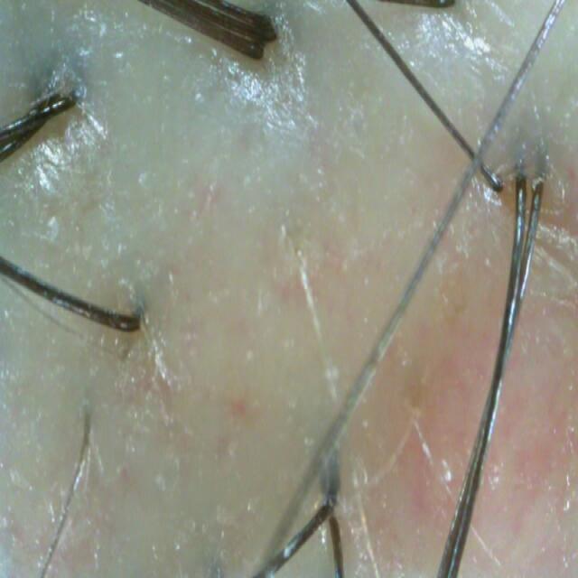 follicle_detection Object Detection Dataset by Hair