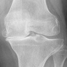 OA Classification Model by OA