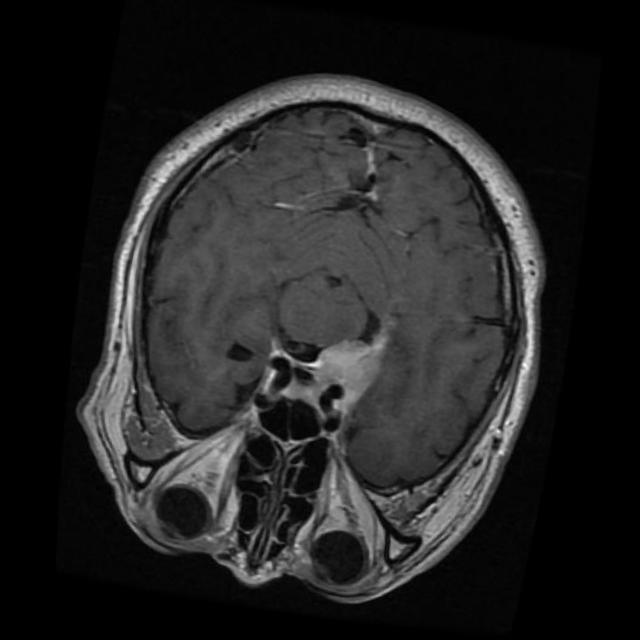 Brain Tumor Capstone Instance Segmentation Dataset by BUBT