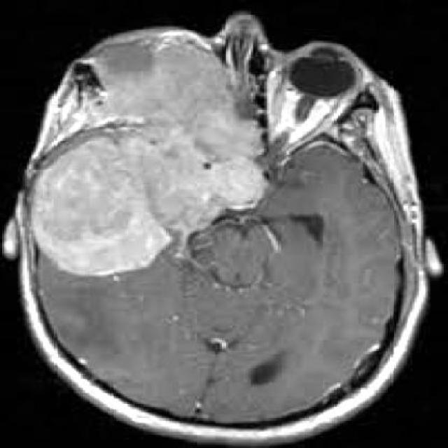 Brain tumor detector 4 Classification Dataset and Pre-Trained Model by ...