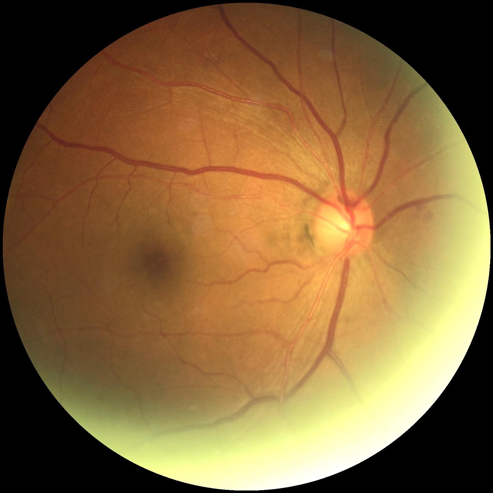 Mutli class eye disease classification Classification Model by gp