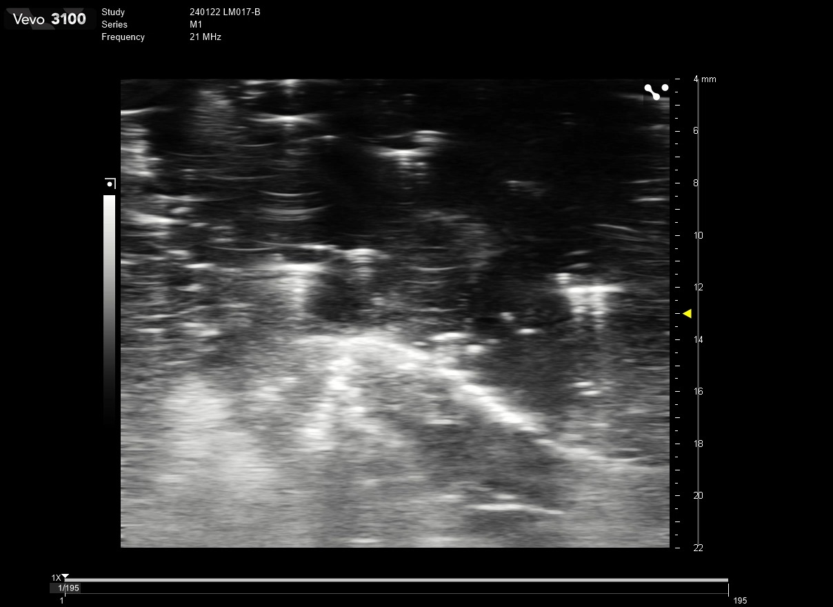 Ultrasound Tumor Segmentation Instance Segmentation Dataset by aliciabilbao