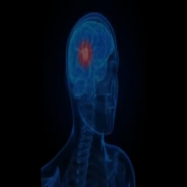 Brain Tumour Object Detection Dataset By Sindhuja