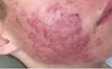 Acne2 - Roboflow Universe