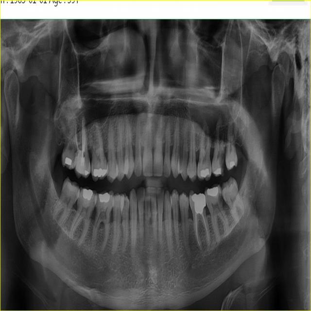 Dental Caries Object Detection Dataset V1 2023 08 15 4 39pm By Magical