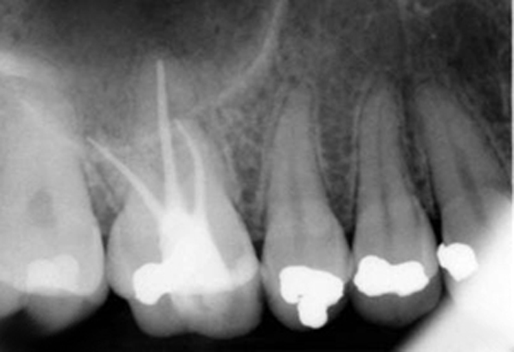exp-caries Object Detection Dataset by magical