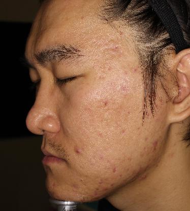 Acne Trac Object Detection Model by Acne Trac