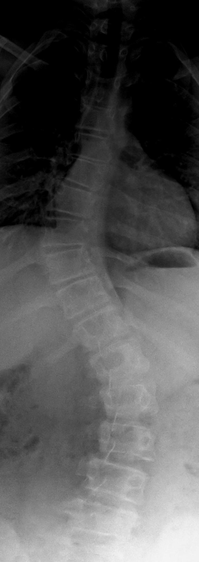 Spine Object Detection Dataset By Vertebrae