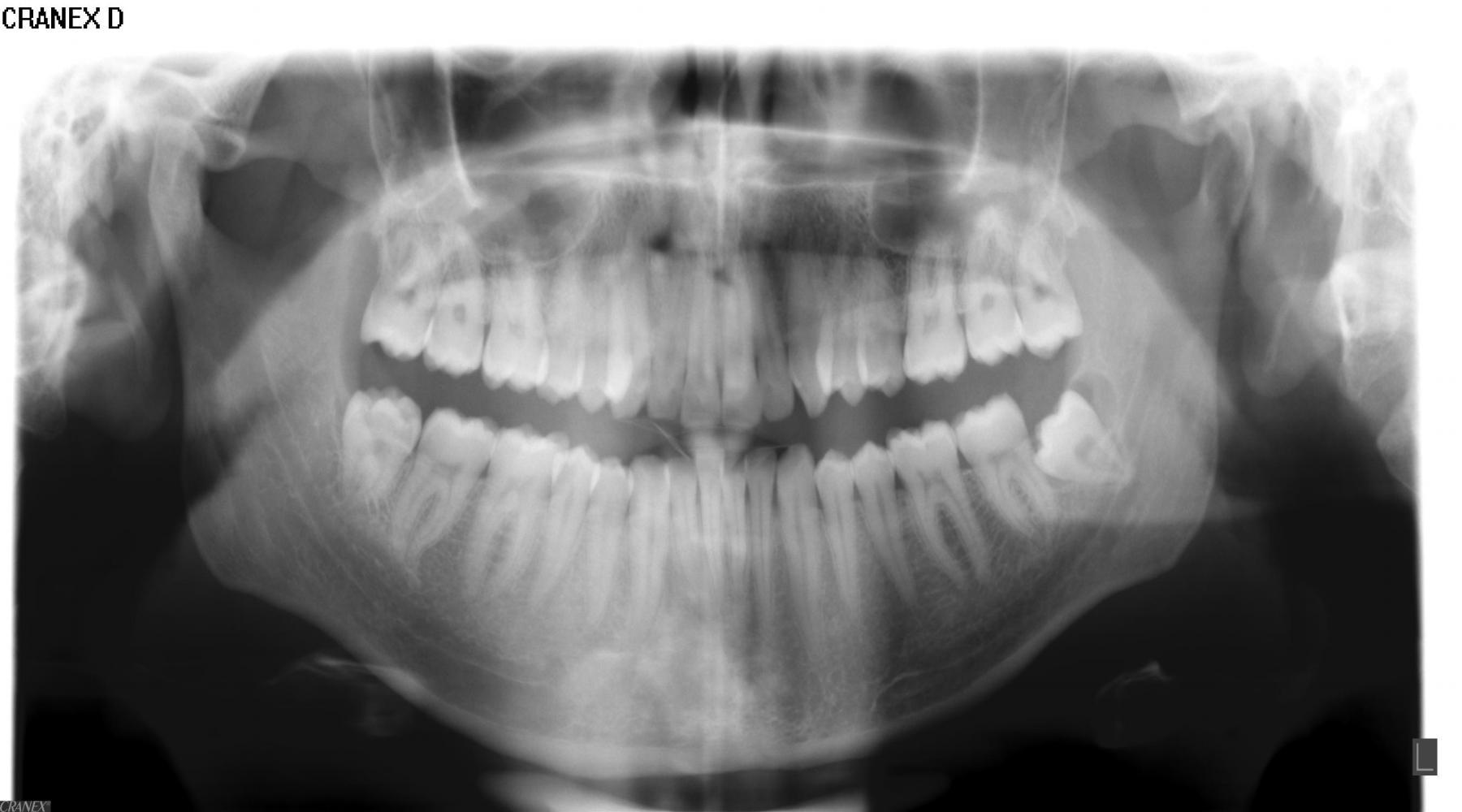Teeth Object Dection Object Detection Dataset By Gbc