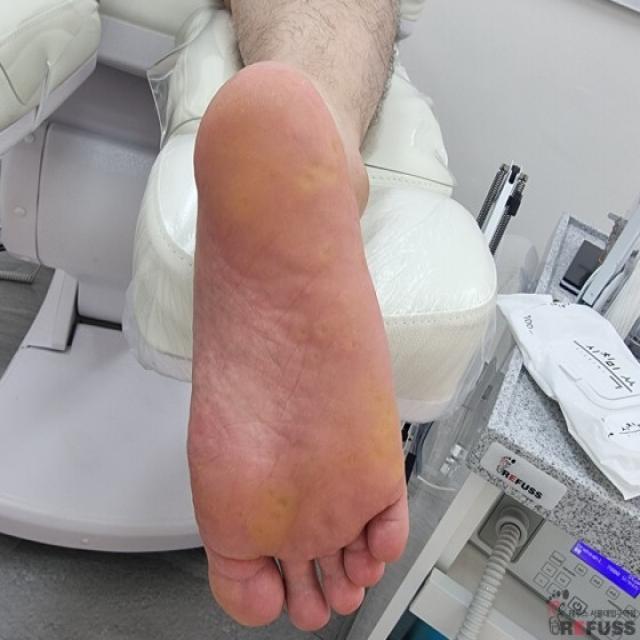 foot ulcer Object Detection Dataset by exelk