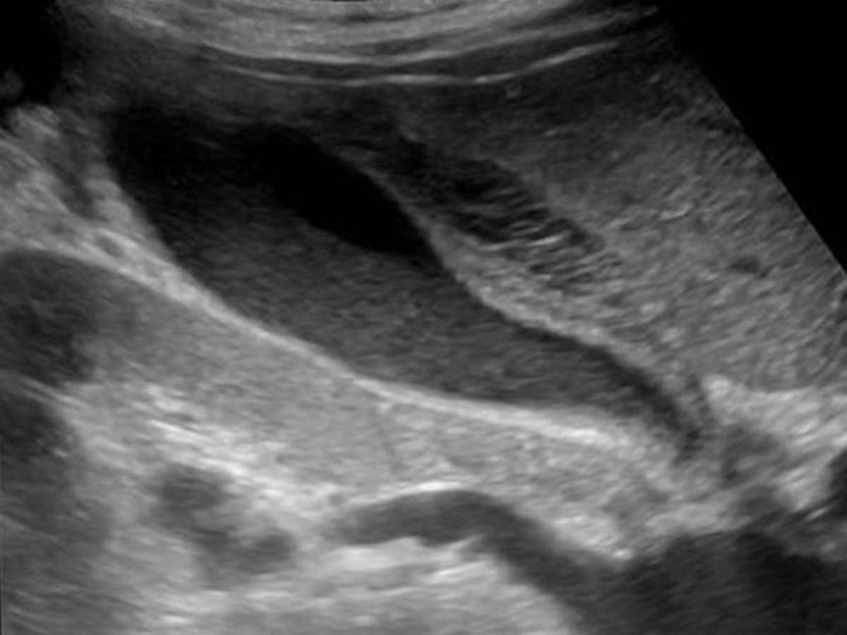 How to Use the 3rd-part-gallbladder Object Detection API