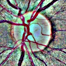 glaucoma retinopathy Classification Model by Retina