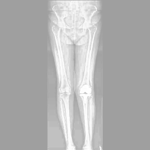 Knee-detector Object Detection Model by Bone Lesion Classifier