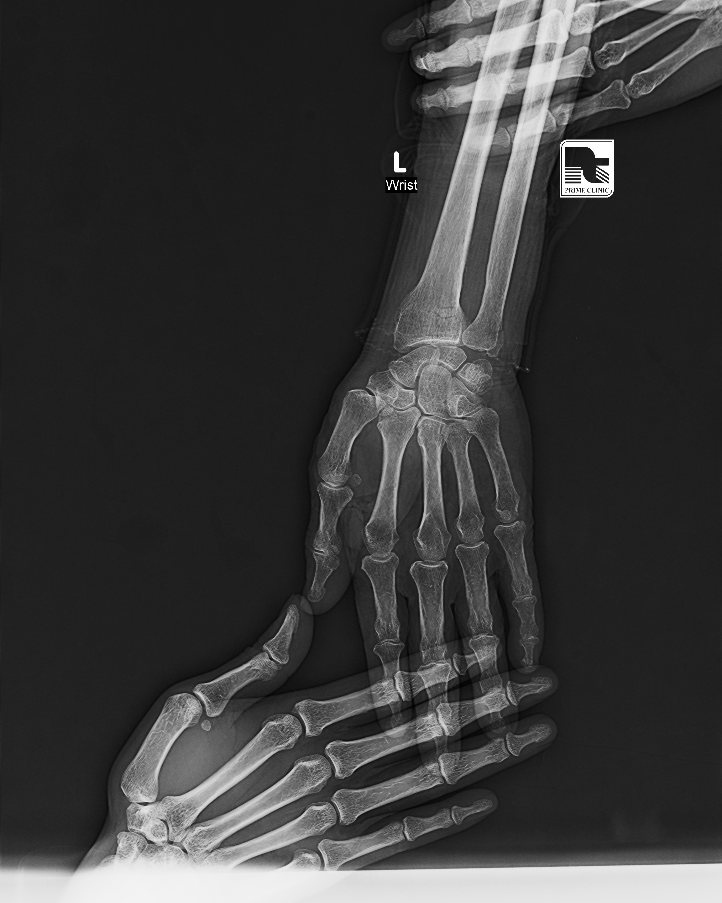 Xray Fractured Dataset Prep Object Detection Dataset And Pre Trained