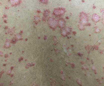 skin diseases Classification Dataset by gabriel