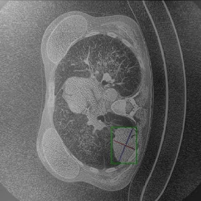 How to Use the chest ct Instance Segmentation API