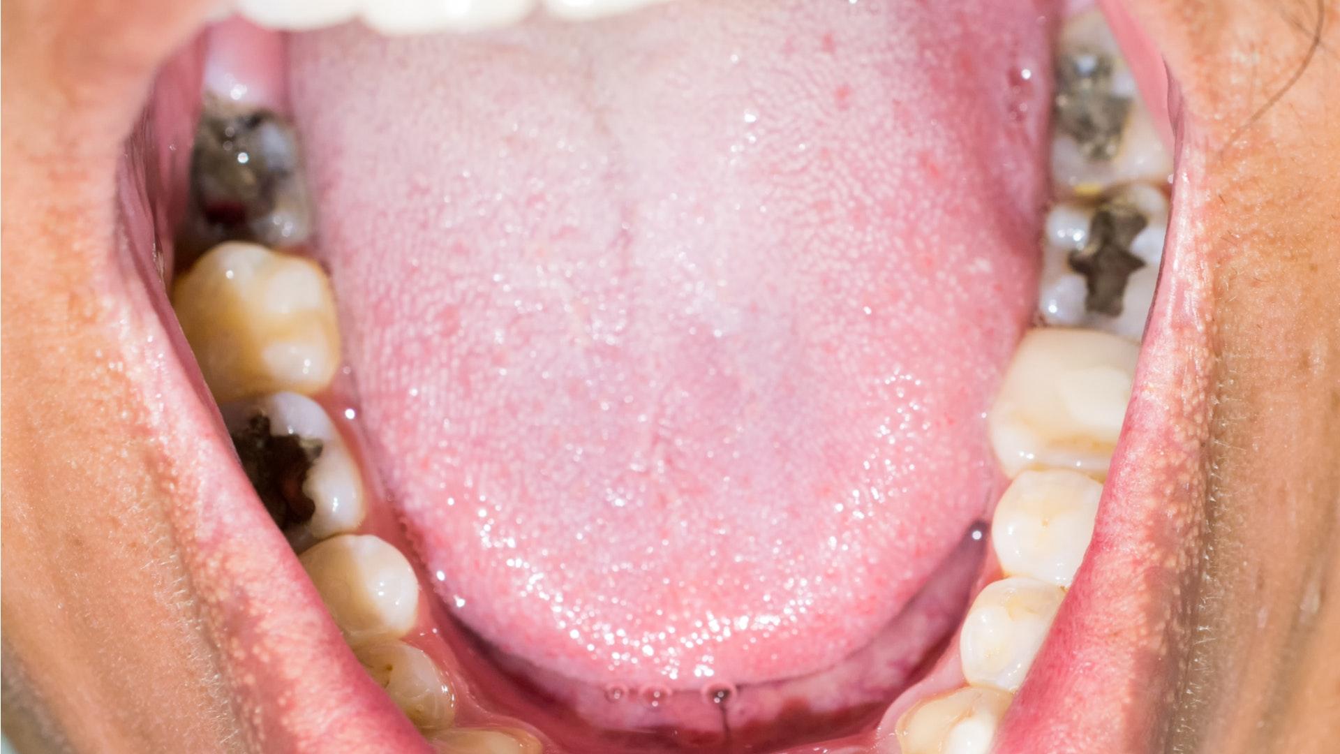 caries-teeth Object Detection Dataset and Pre-Trained Model by ibn