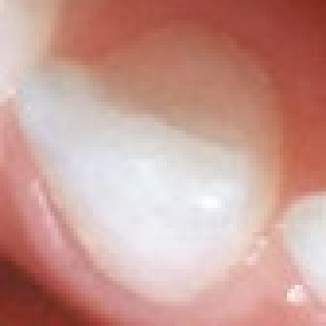 caries Object Detection Dataset and Pre-Trained Model by ibn