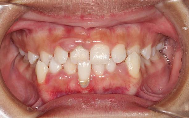 calculus Object Detection Dataset and Pre-Trained Model by Ashvikha