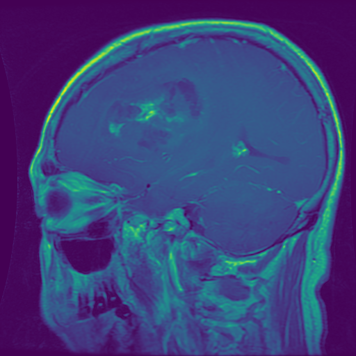 brain tumor trial Object Detection Dataset by research