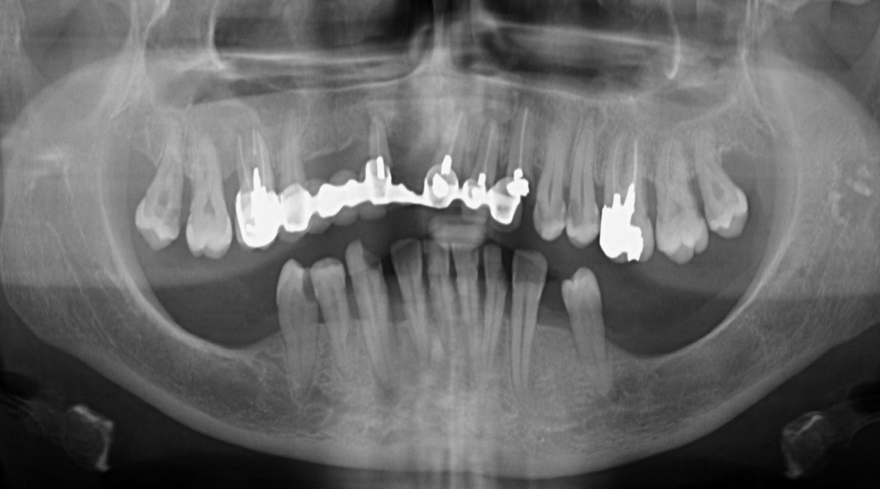 Tooth instance segmentation Object Detection Model by khaled