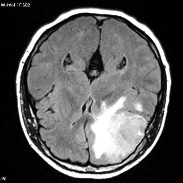 Tumor Object Detection Model by Pravalika