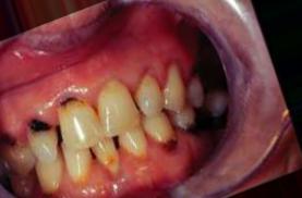 tooth_decay test Object Detection Dataset by project