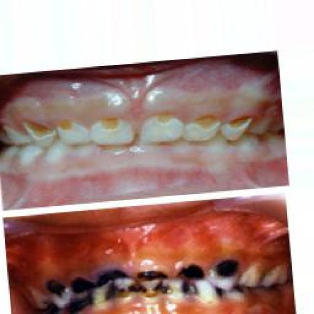 tooth_decay 3 test final Object Detection Dataset by project