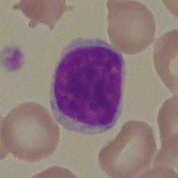 Leukimia Segmentasi - Roboflow Universe