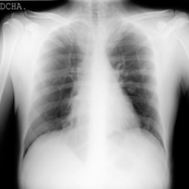 How to Use the LUNG CANCER Object Detection API