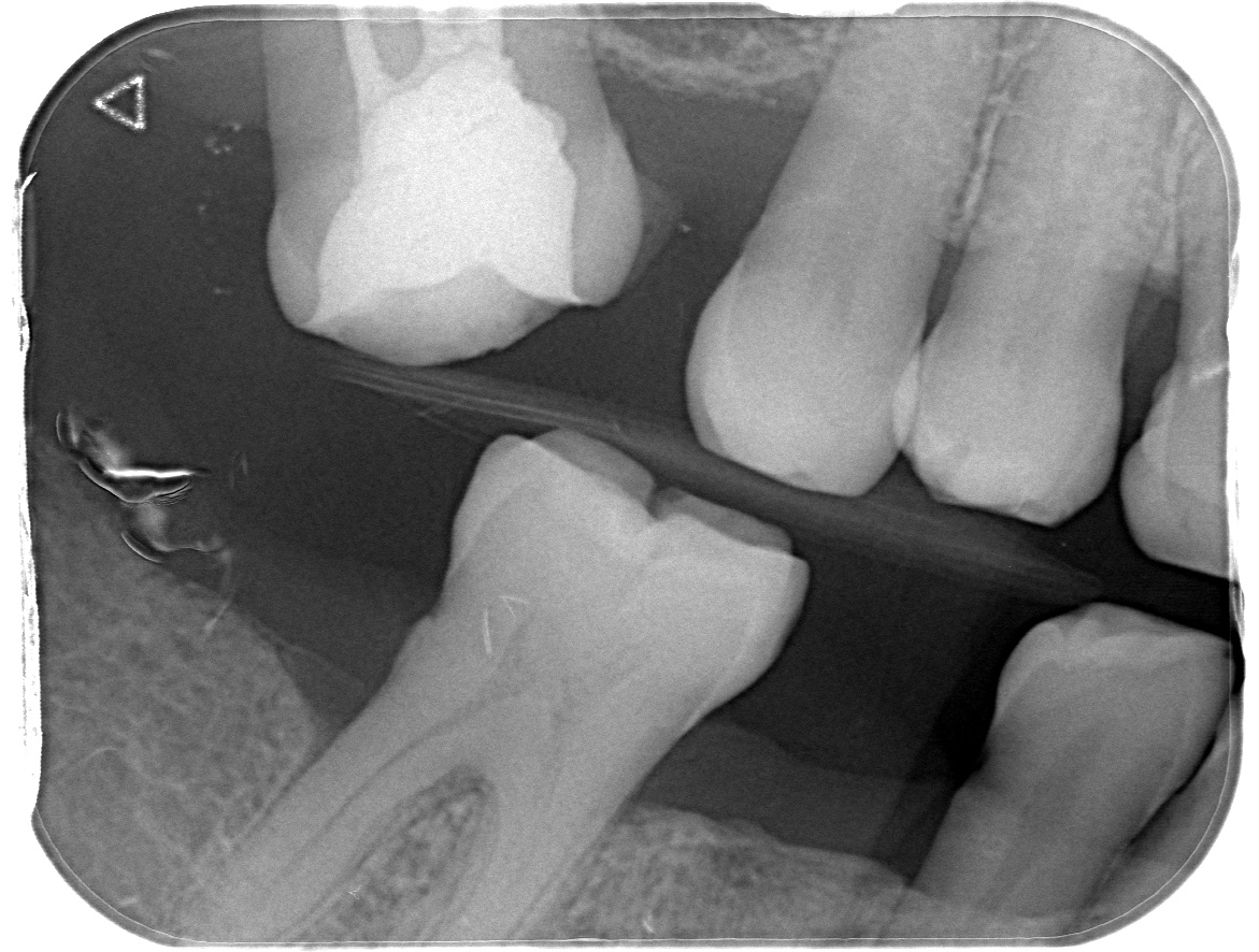 Bitewing_sag_aug_train Object Detection Dataset by Craoni