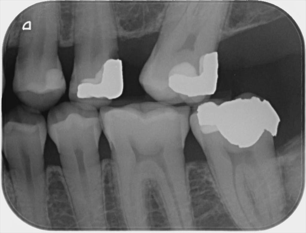 Bitewing_sol_aug_valid Object Detection Dataset by Craoni