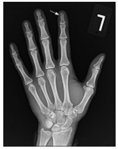 Fracture_detection Object Detection Model by yooooooooooooooooooooooooooo