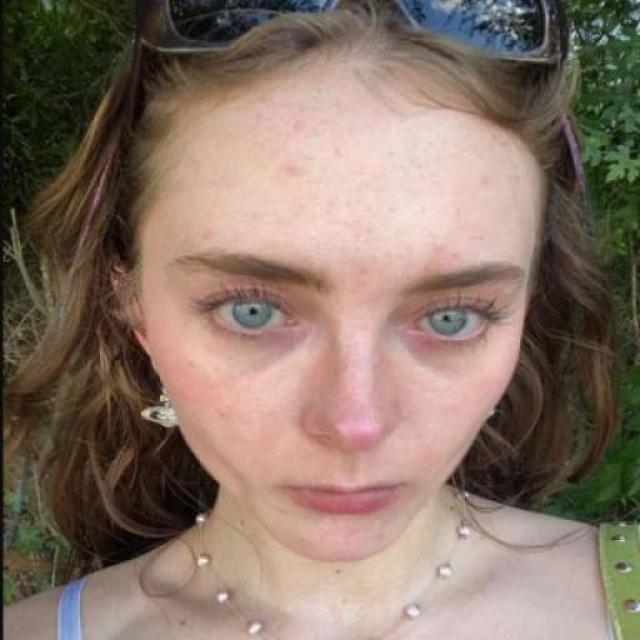 skin problems detect Object Detection Dataset (v1, 2023-09-06 11:26pm ...