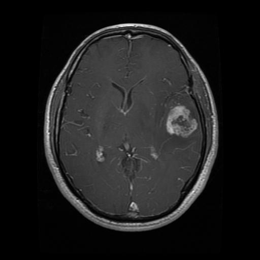 BRAIN TUMOR FINAL Object Detection Model (v6, 2026-02-01 5:49pm) by ...