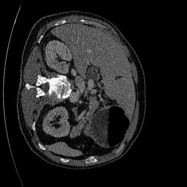 Liver Tumor SemanticSegmentation Semantic Segmentation Dataset and Pre-Trained Model by nabilah