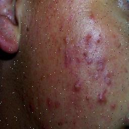 Skin Disease Detection Object Detection Model by Skin disease