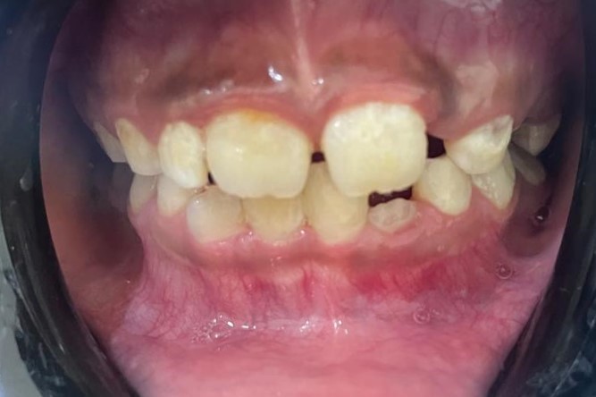 caries-seg Instance Segmentation Dataset by nasdevsroboflow
