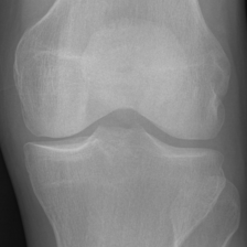 Knee Osteoarthritis Dataset Object Detection Model By Chima