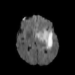 brain tumer (brain-tumer-ruyna) - Roboflow Universe