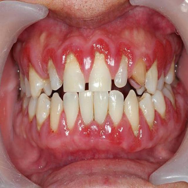 gum-disease Instance Segmentation Dataset by Pranta