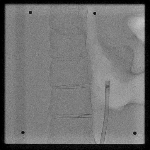 Cath Object Detection Dataset and Pre-Trained Model by CatheterProject