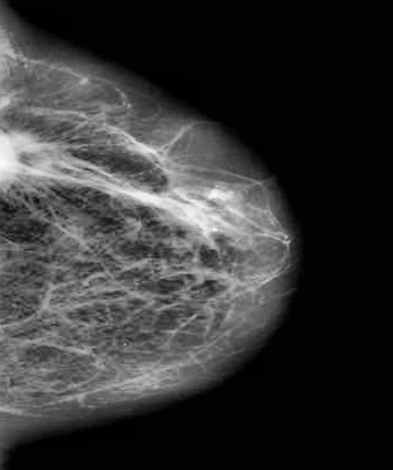 bc Object Detection Model by breast cancer detection
