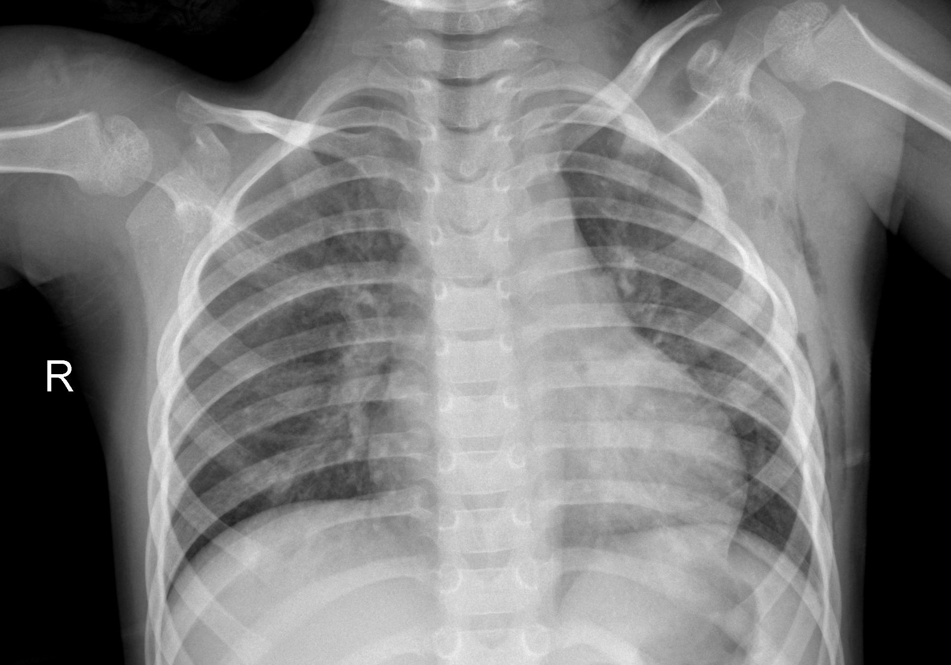 chest xray Classification Dataset and Pre-Trained Model by Parichaya Boonsoong