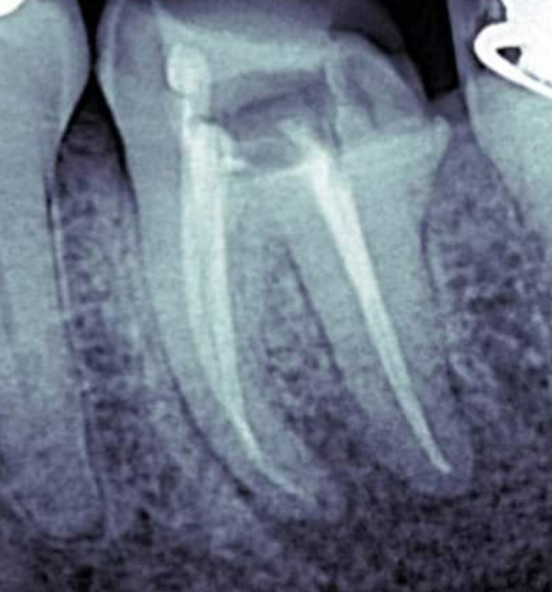 Tooth Object Detection Dataset and Pre-Trained Model by Brac University