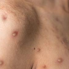 Monkeypox Detection Object Detection Dataset and Pre-Trained Model by University of Asia Pacific