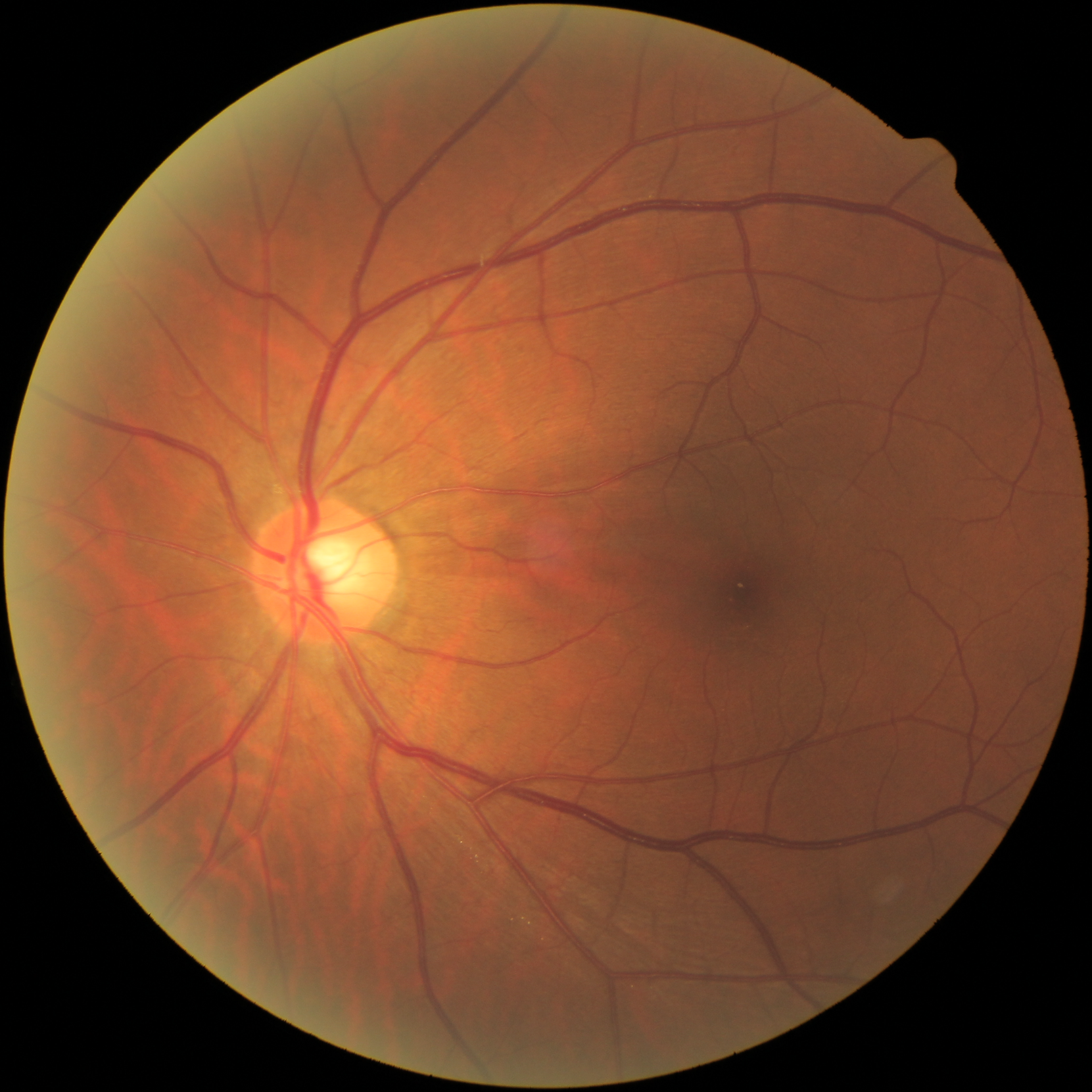 cataract classification Classification Model by SLIIT