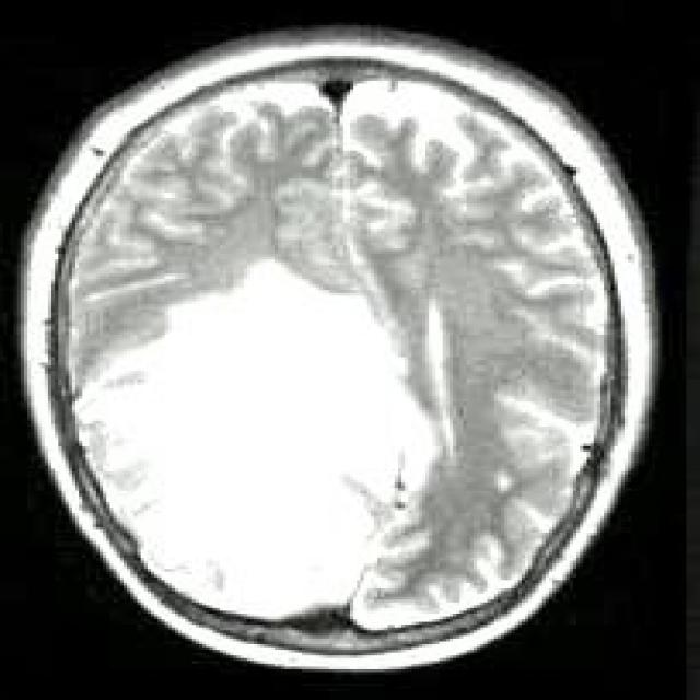 How to Use the MRI-Tumor-Detection2 Instance Segmentation API