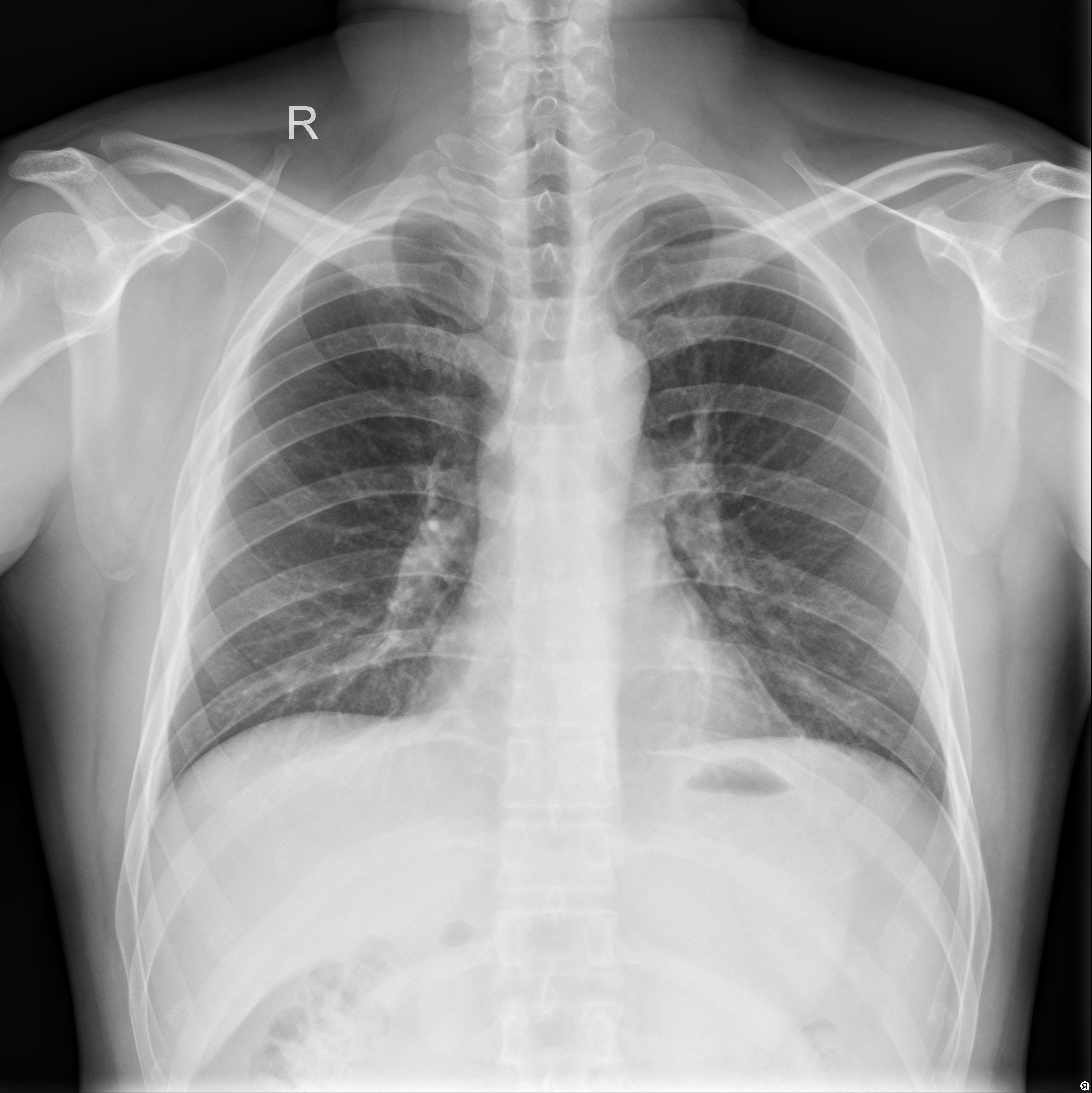 CXR for TB Classification Model by Image Processing